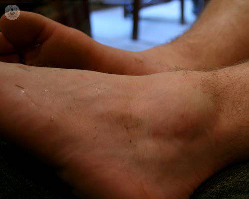 Cómo actuar tras una lesión de tobillo | Top Doctors